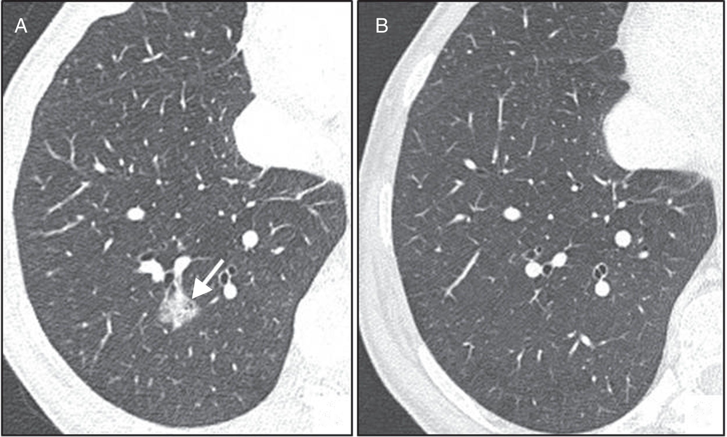 Nódulo pulmonar incidental: caracterización y manejo | Radiología