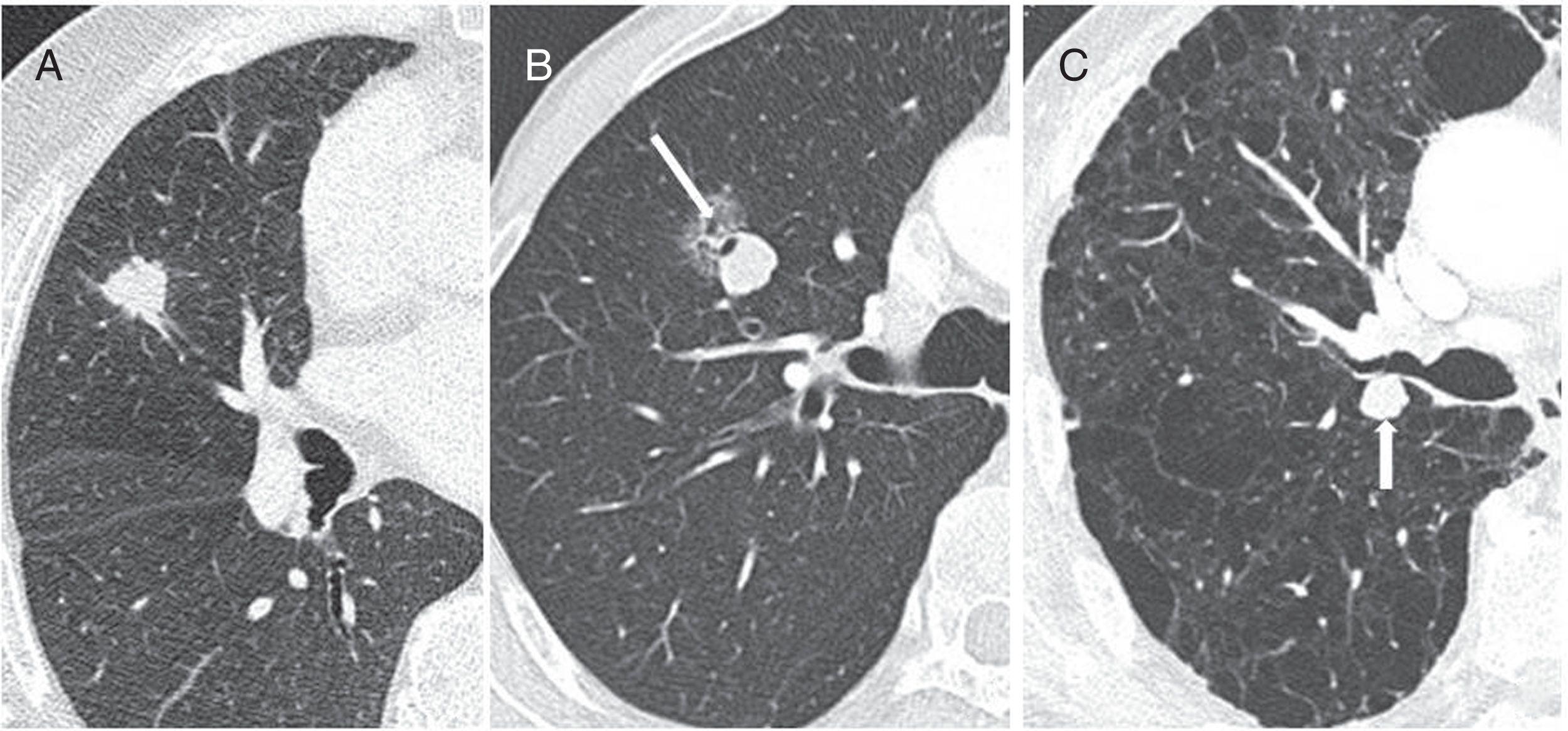 Nódulo pulmonar incidental: caracterización y manejo | Radiología