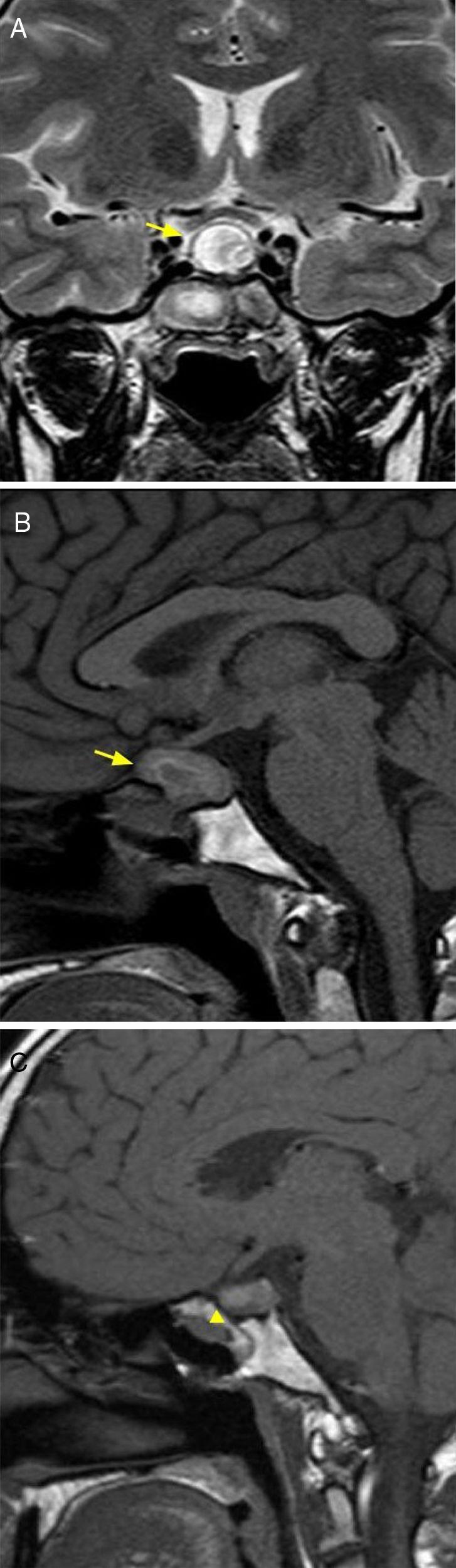 Región selar: evaluación mediante resonancia magnética de lesiones ...