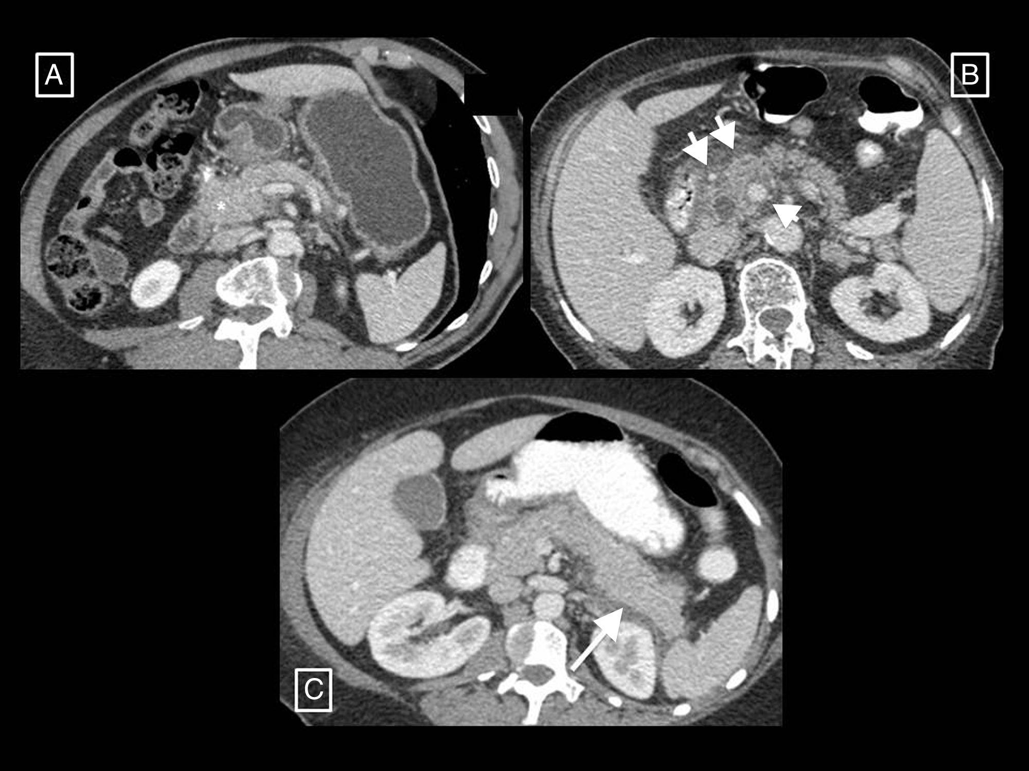Radiología de la pancreatitis aguda hoy: clasificación de Atlanta y ...