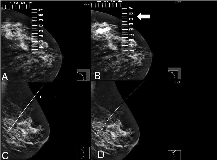 Arpón quirúrgico vs. semilla de iodo (125I) en la localización de ...