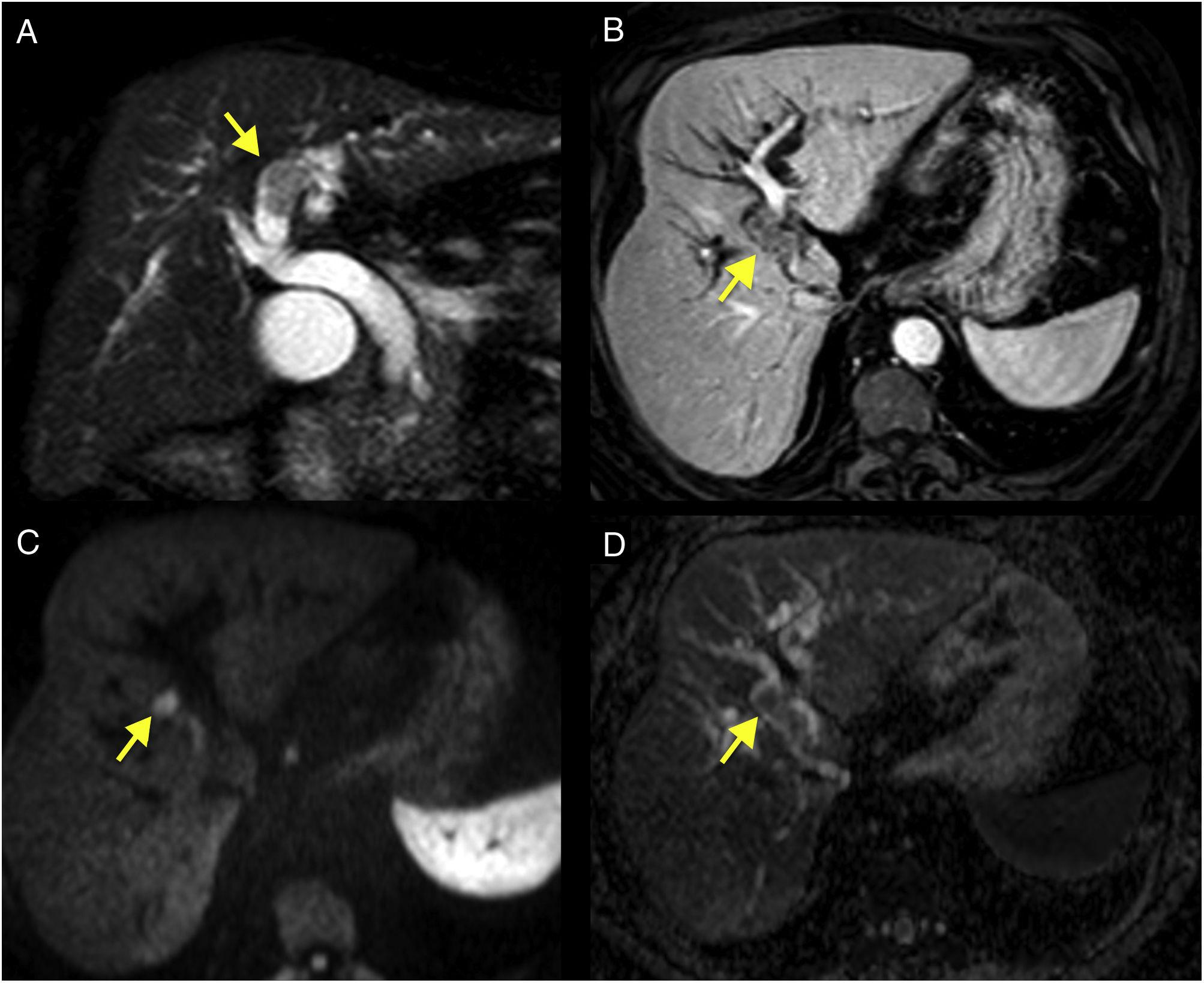 Neoplasia papilar intraductal de la vía biliar: radiología en una nueva ...