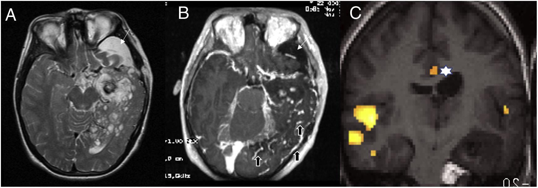 Crisis epiléptica: ¿cómo interpretar la imagen? Correlación clínica ...