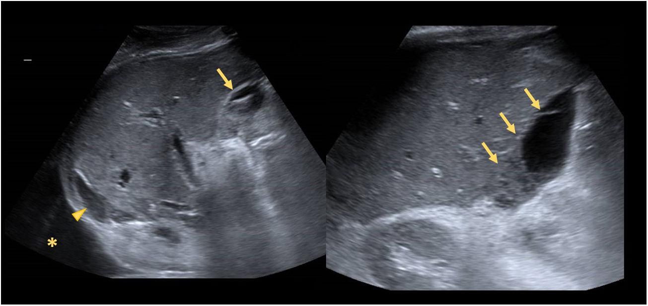 Hallazgos ecográficos transitorios y normales en el postoperatorio ...