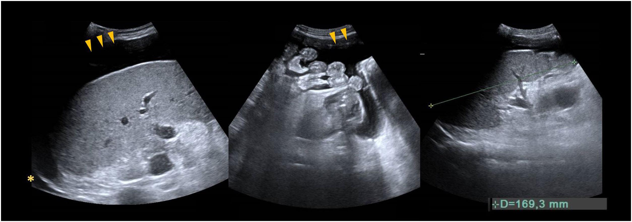 Hallazgos ecográficos transitorios y normales en el postoperatorio ...