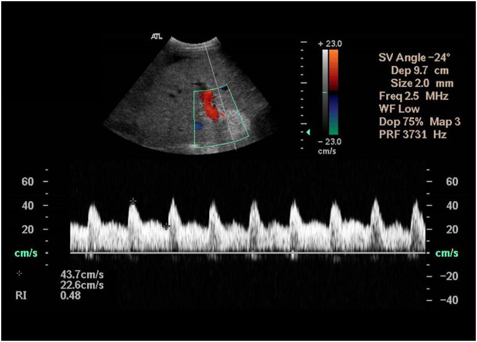 Hallazgos ecográficos transitorios y normales en el postoperatorio ...