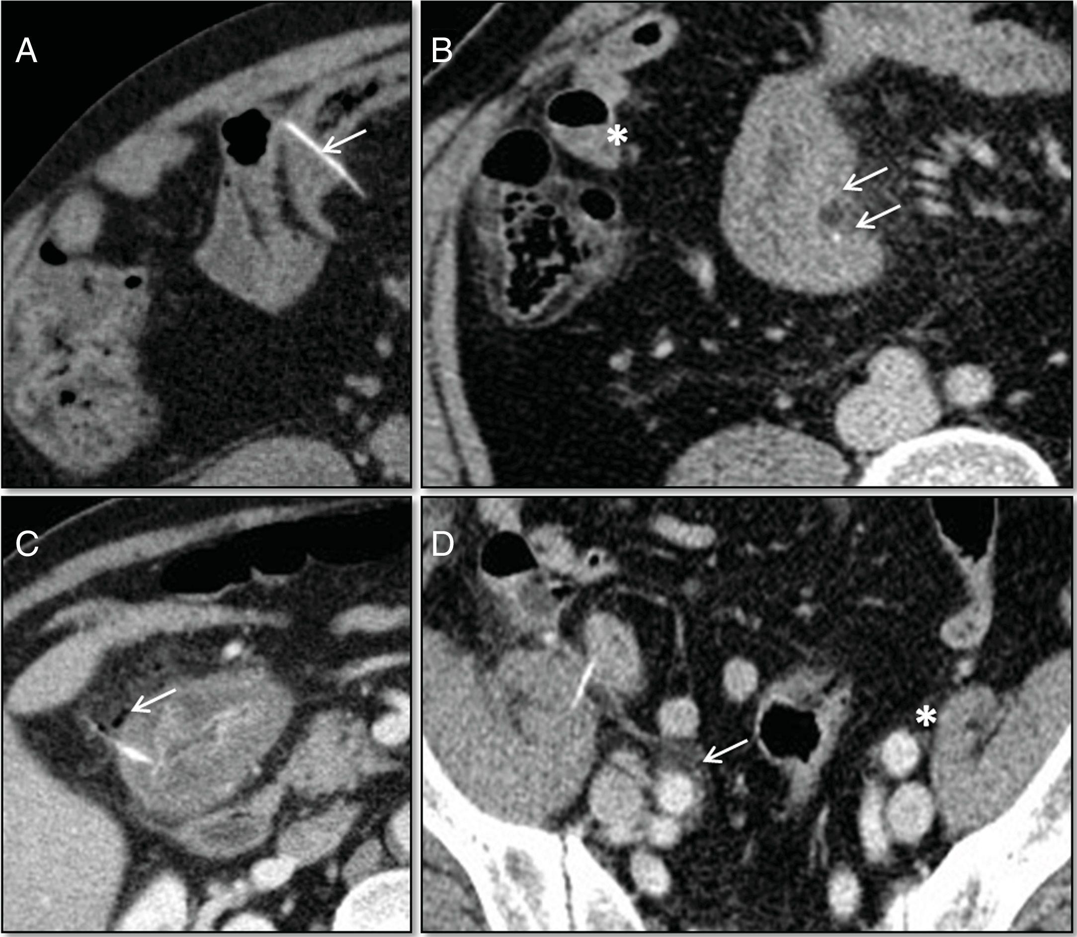Perforación gastrointestinal por espina de pescado. Hallazgos ...