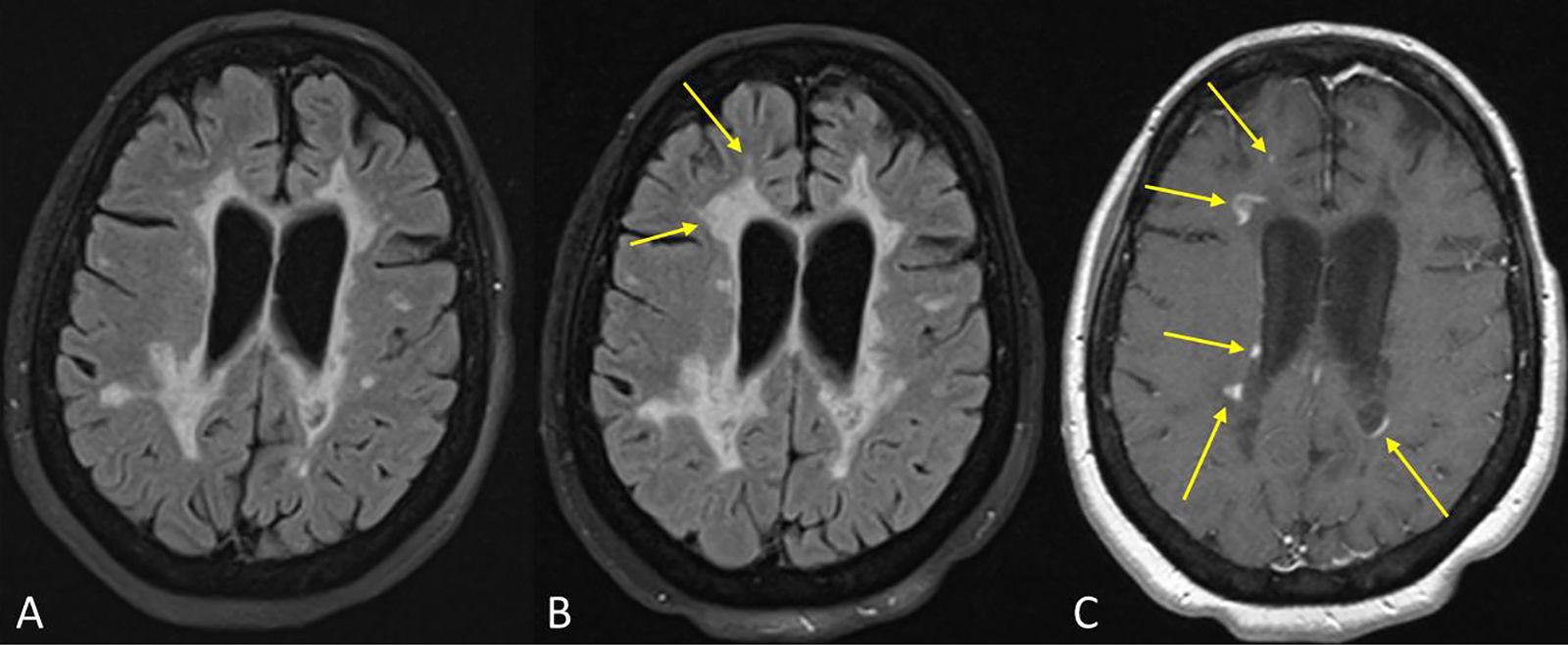 Nuevos conceptos sobre el papel de la resonancia magnética en el ...