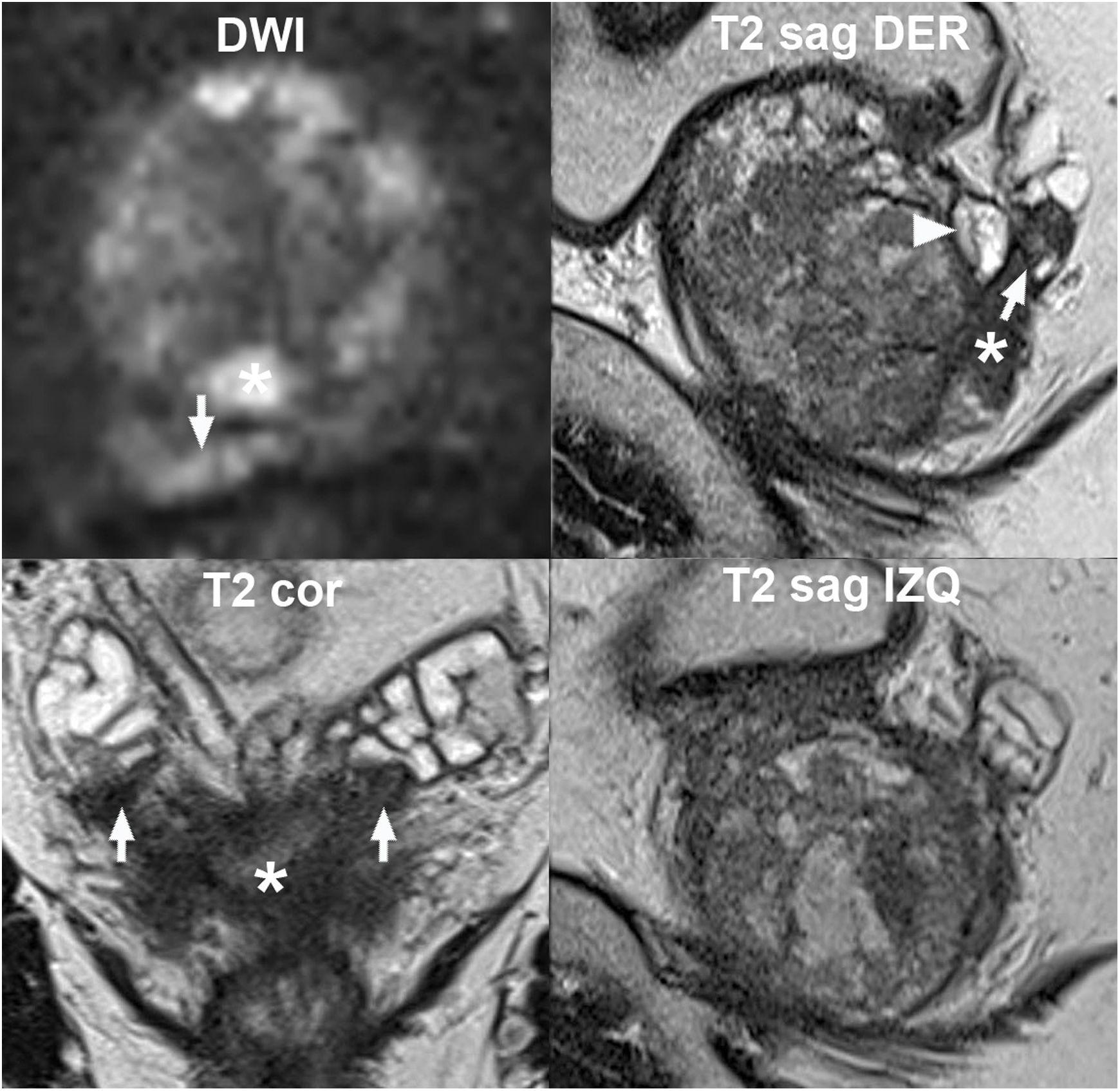 Resonancia magnética de próstata: guía práctica de interpretación e ...