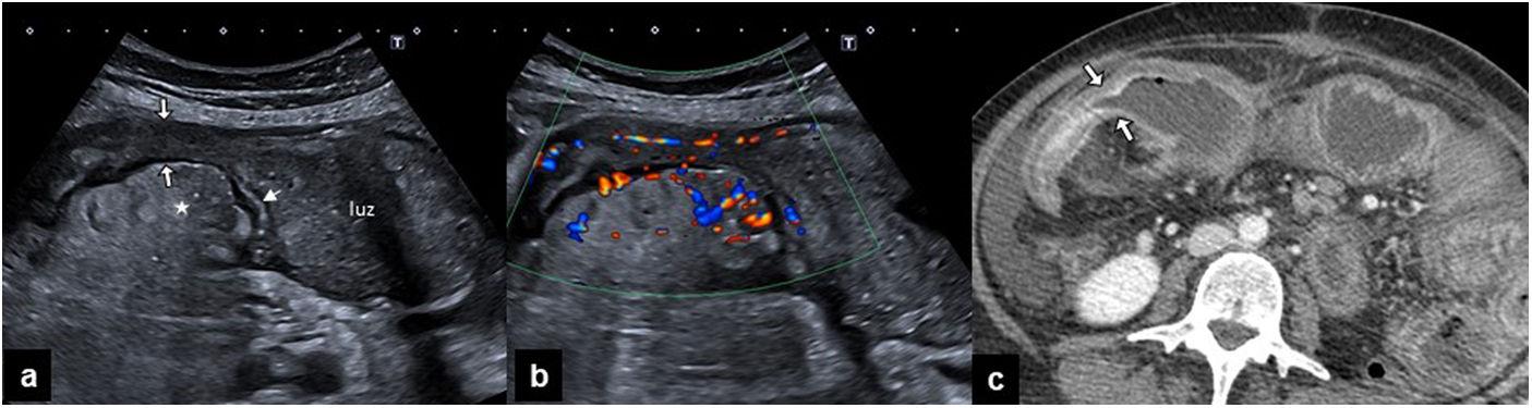 Ecografía intestinal: técnicas de examen, patrones normales y ...
