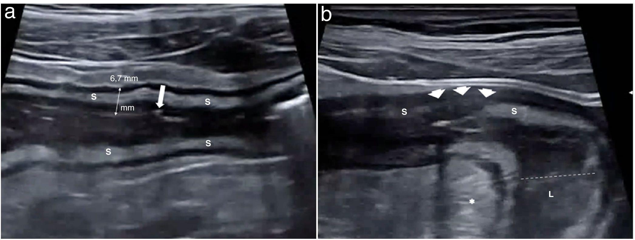 Utilidad de la ecografía intestinal en la enfermedad inflamatoria ...