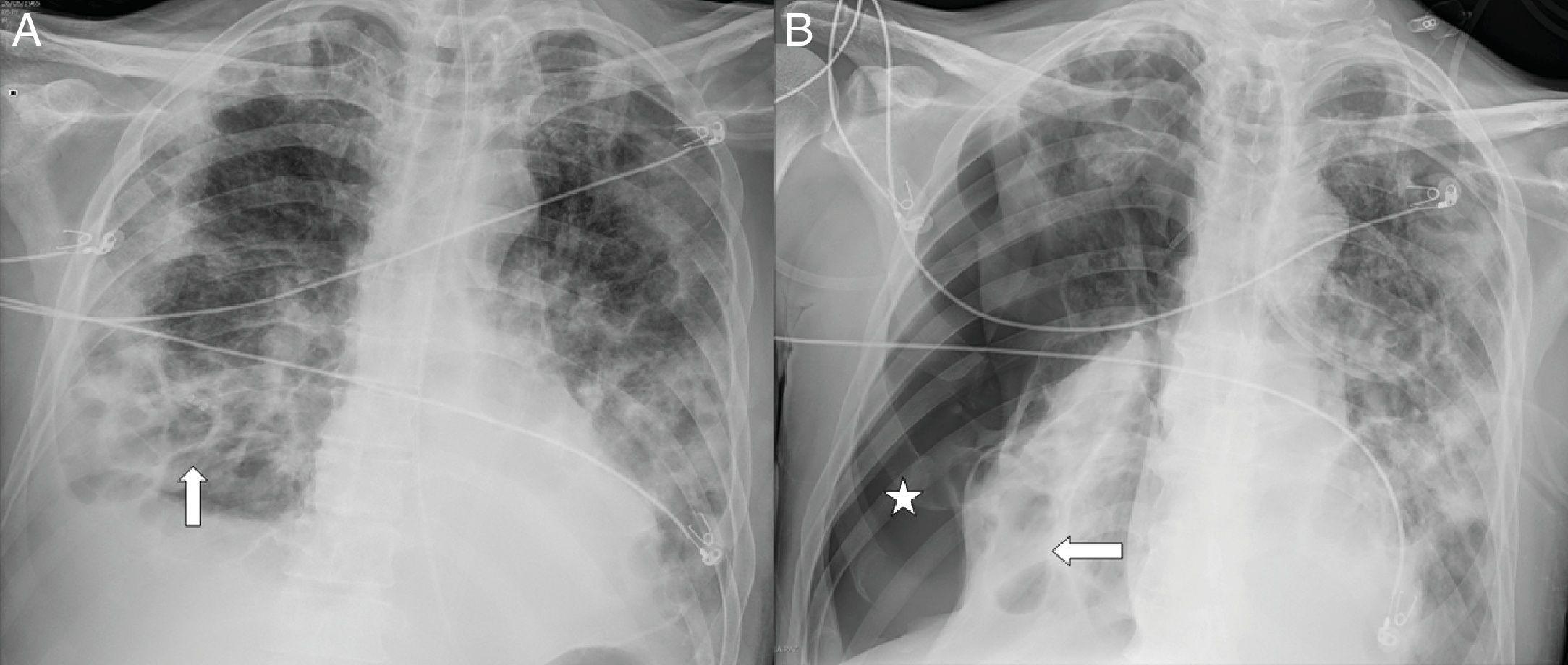 Aspectos radiológicos de la neumonía COVID-19: evolución y ...