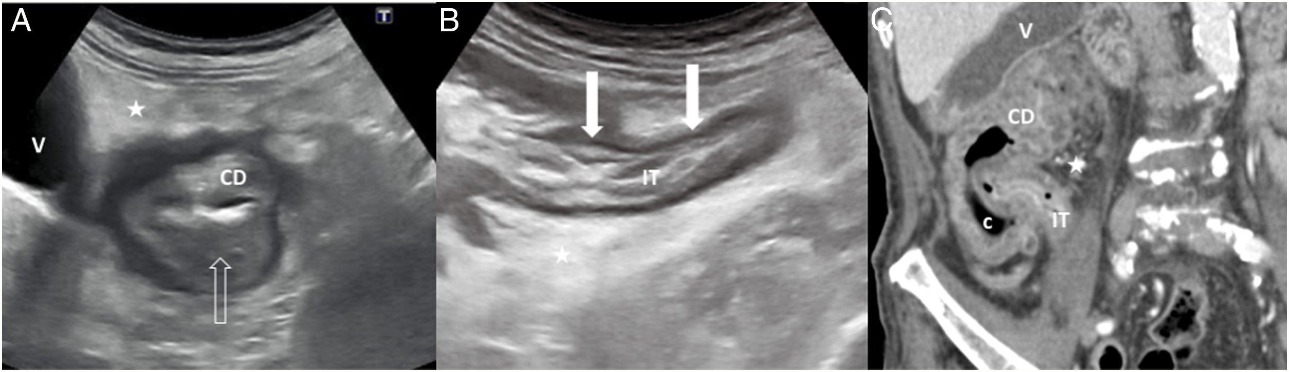 Ecografía intestinal y abdomen agudo: más allá de la apendicitis aguda ...