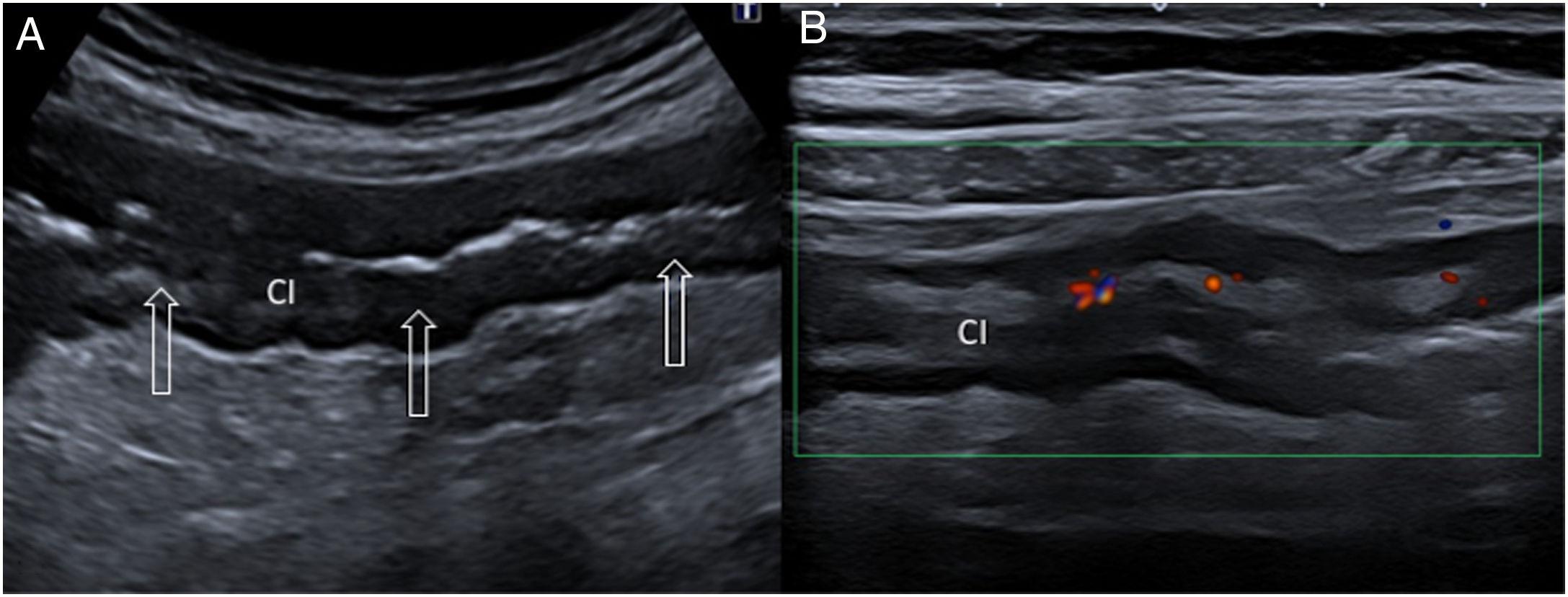 Ecografía intestinal y abdomen agudo: más allá de la apendicitis aguda ...