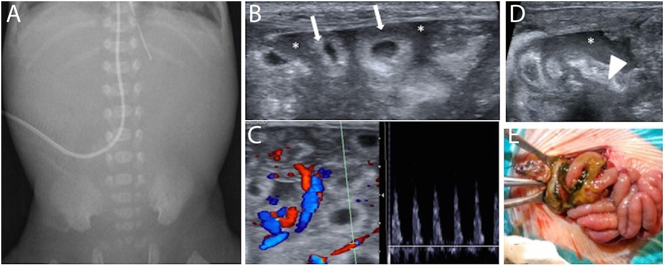 Ecografía intestinal en pediatría | Radiología