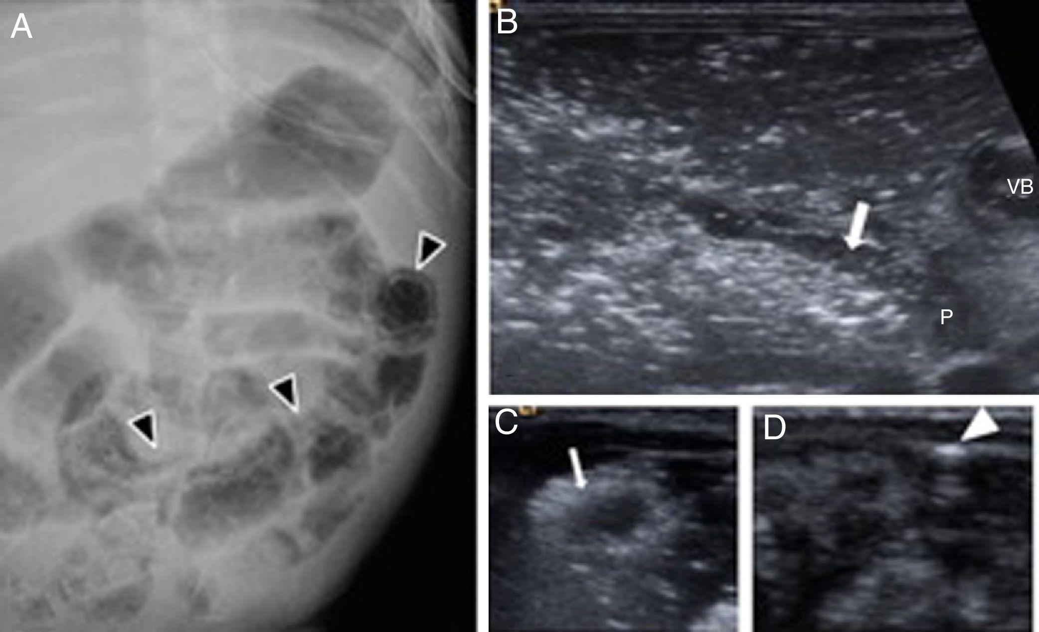 Ecografía intestinal en pediatría | Radiología