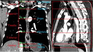 Cáncer de esófago: revisión actualizada del TNM y de sus complicaciones ...