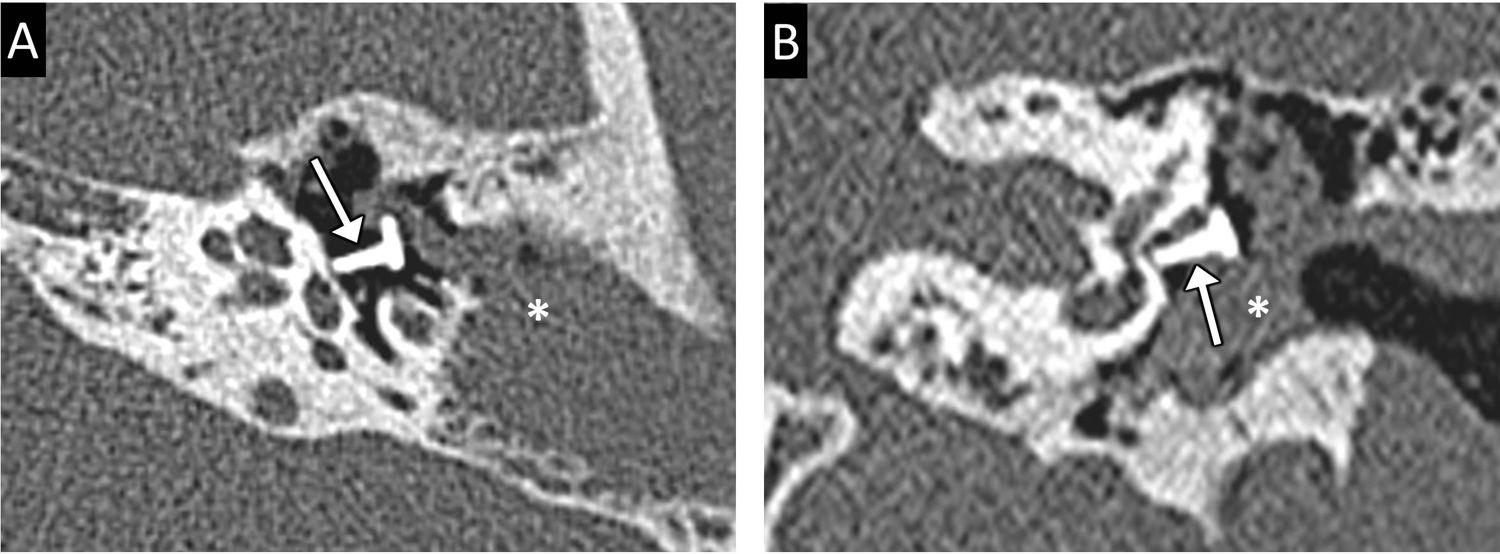 Valoración radiológica del oído medio operado | Radiología