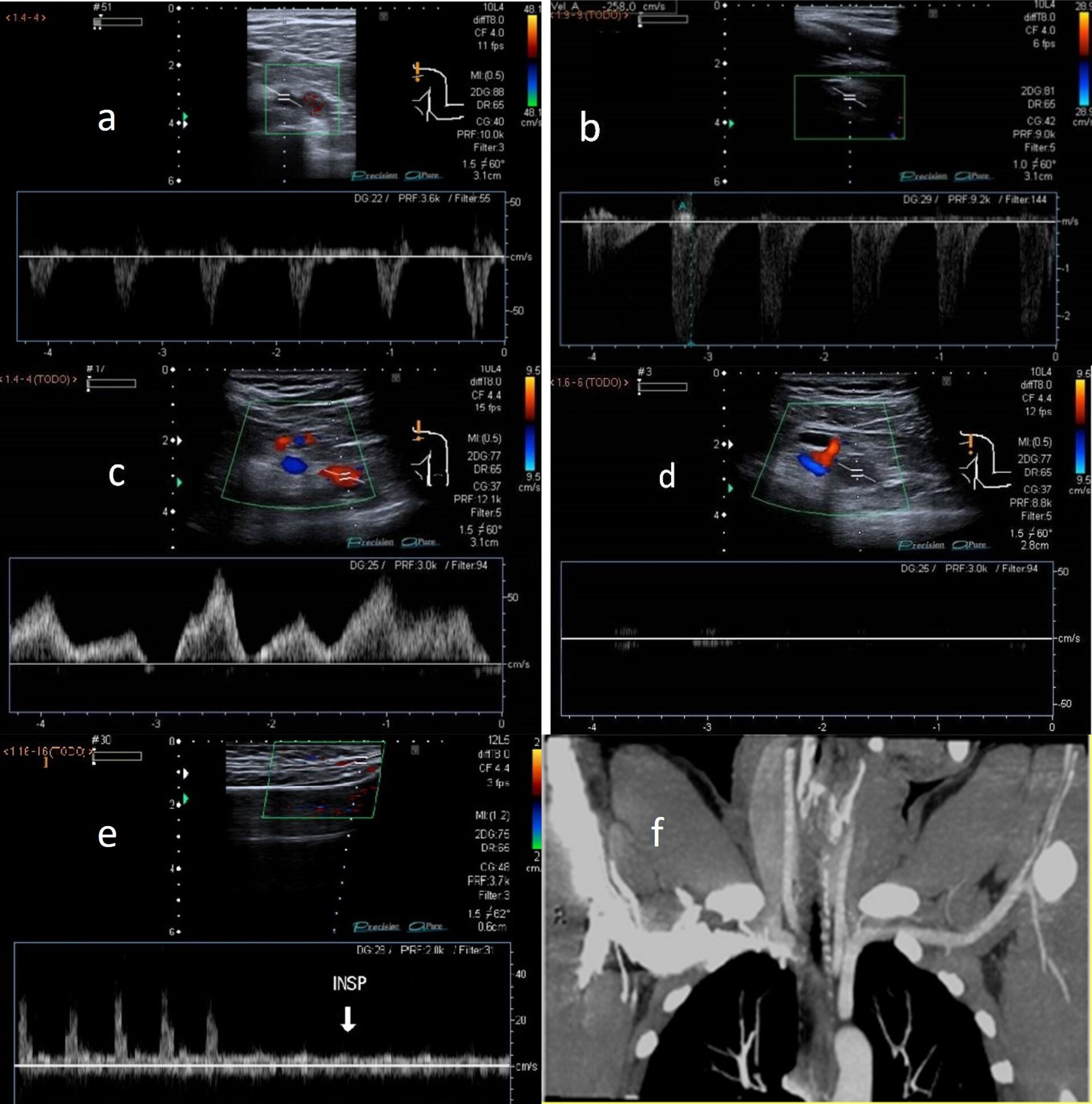 Síndromes de compresión vascular. Valor de la ecografía Doppler ...