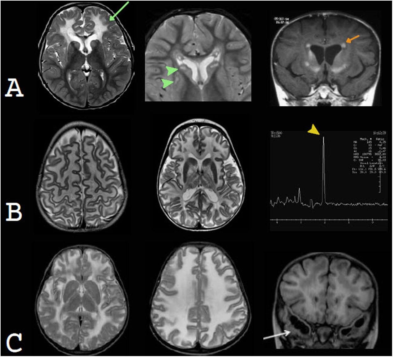 Radiología en el estudio de la macrocefalia. ¿Por qué?, ¿cuándo?, ¿cómo ...