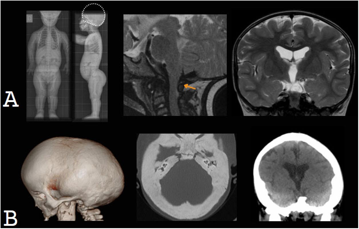 Radiología en el estudio de la macrocefalia. ¿Por qué?, ¿cuándo?, ¿cómo ...
