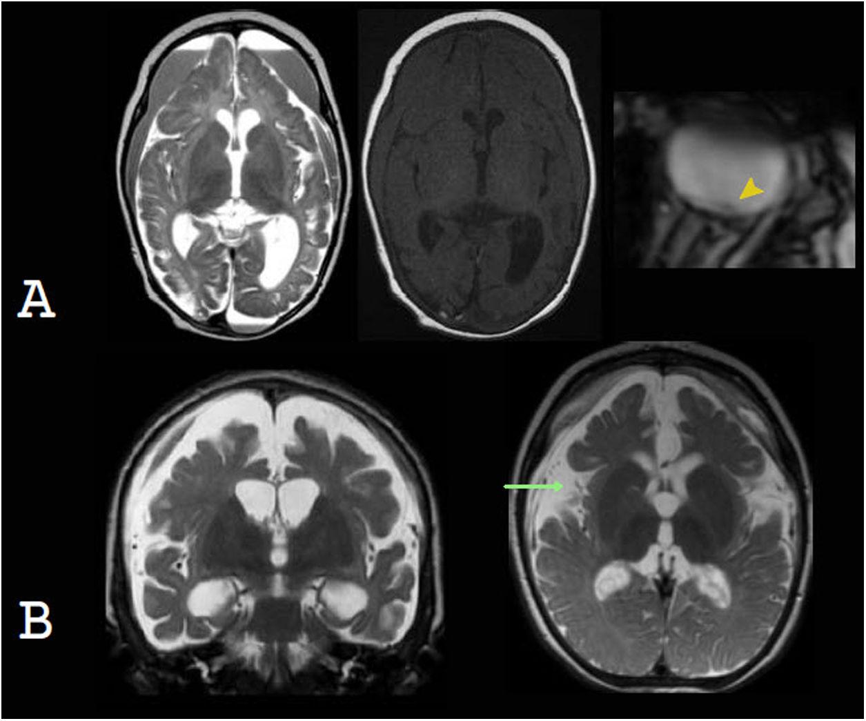 Radiología en el estudio de la macrocefalia. ¿Por qué?, ¿cuándo?, ¿cómo ...