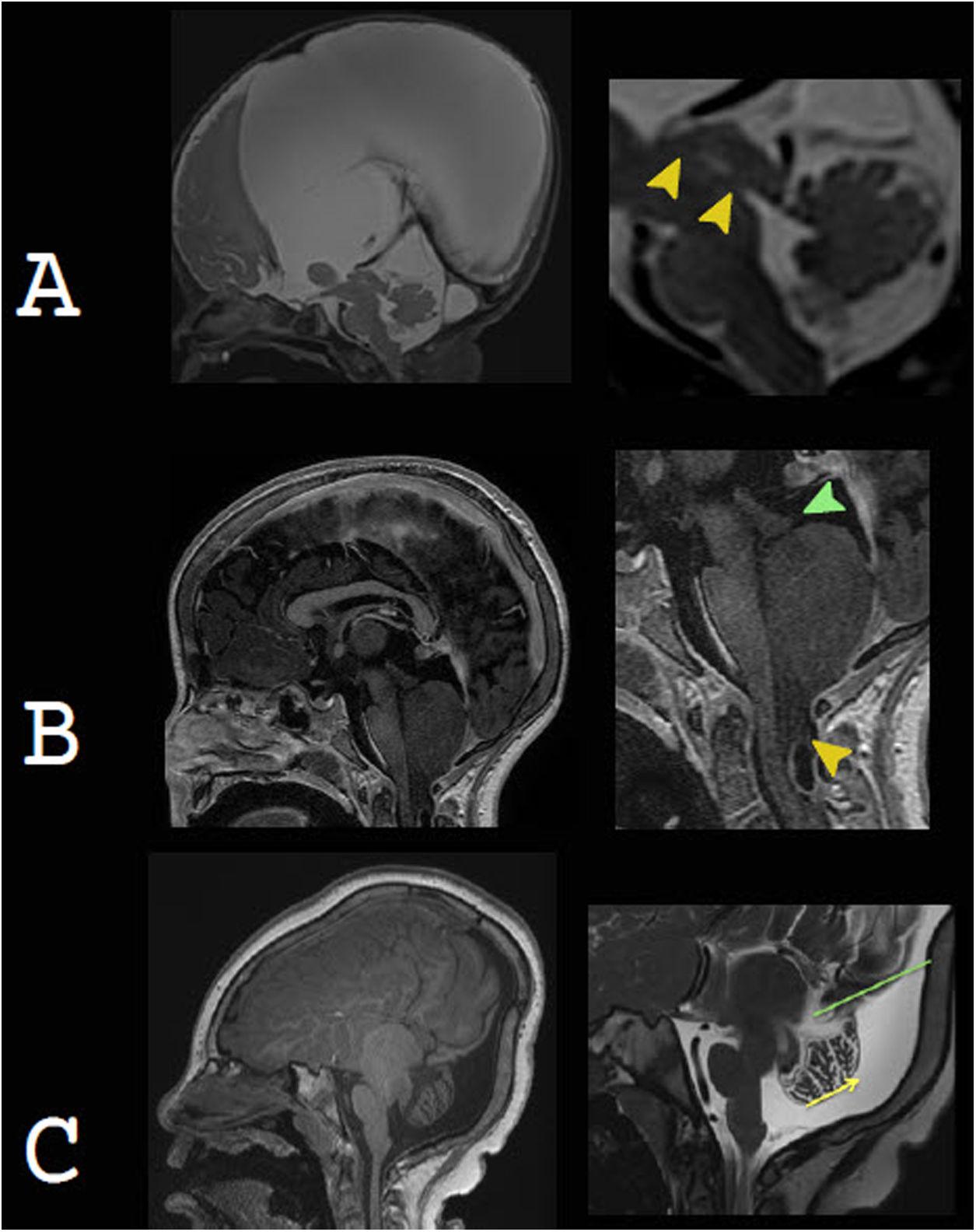 Radiología en el estudio de la macrocefalia. ¿Por qué?, ¿cuándo?, ¿cómo ...