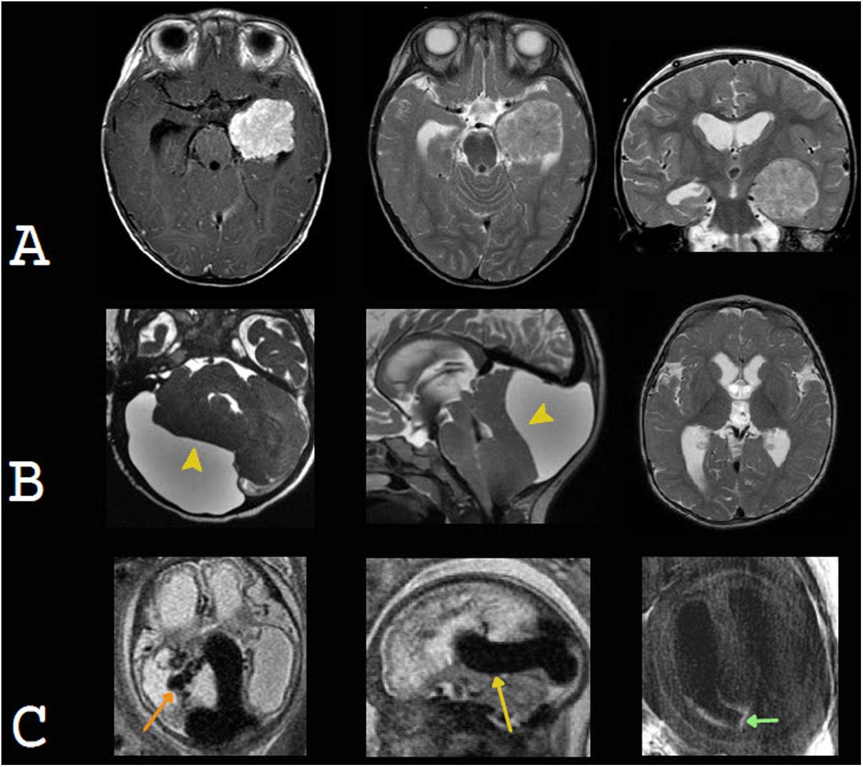 Radiología en el estudio de la macrocefalia. ¿Por qué?, ¿cuándo?, ¿cómo ...