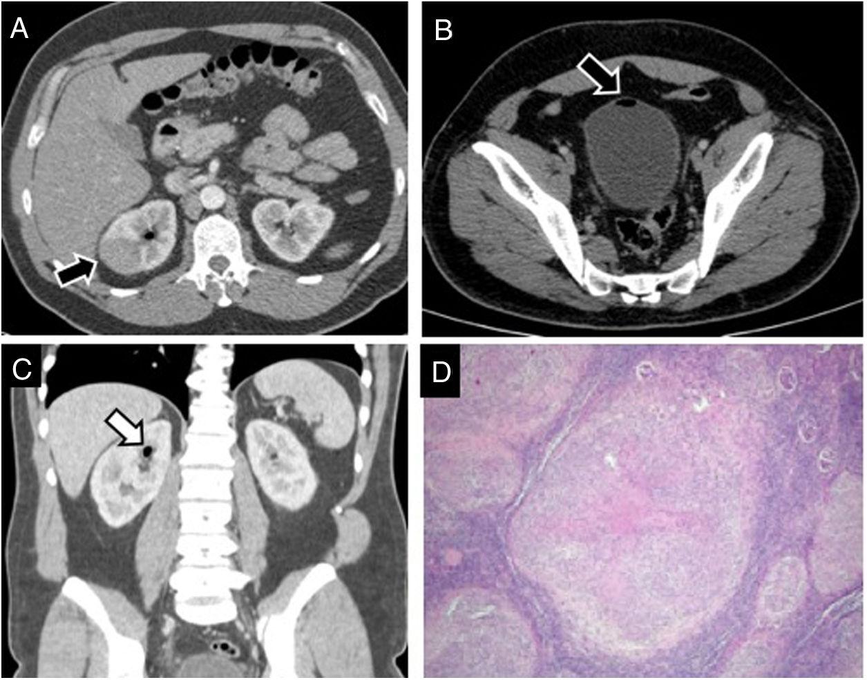 Afectación renal granulomatosa después de tratamiento con BCG de un ...