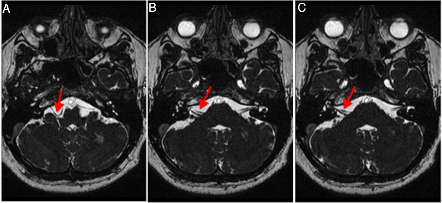 Correlación clínico-radiológica del asa vascular del ángulo ...
