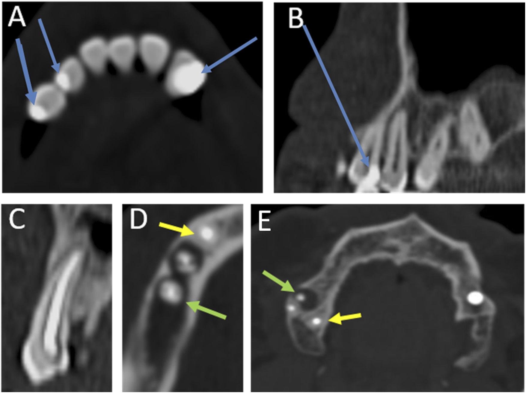 Hallazgos por imagen de patología dentaria en tomografía computarizada ...