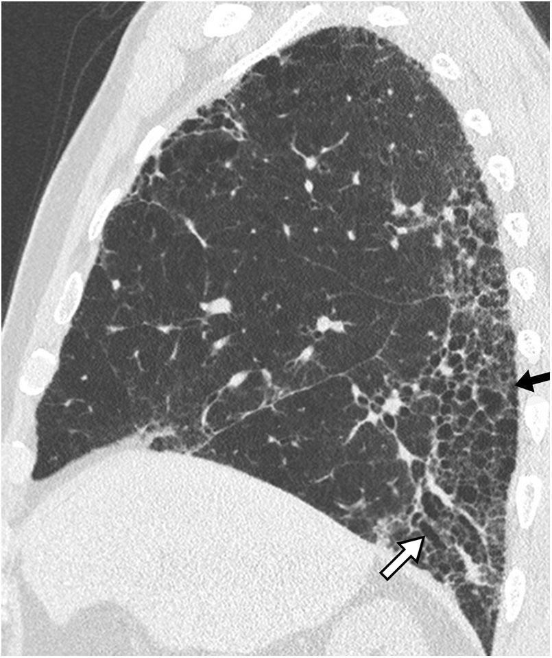 El informe radiológico en patología intersticial pulmonar | Radiología