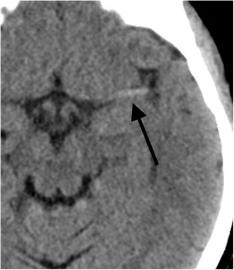 Informe radiológico de la TC multimodal en los pacientes con ictus ...