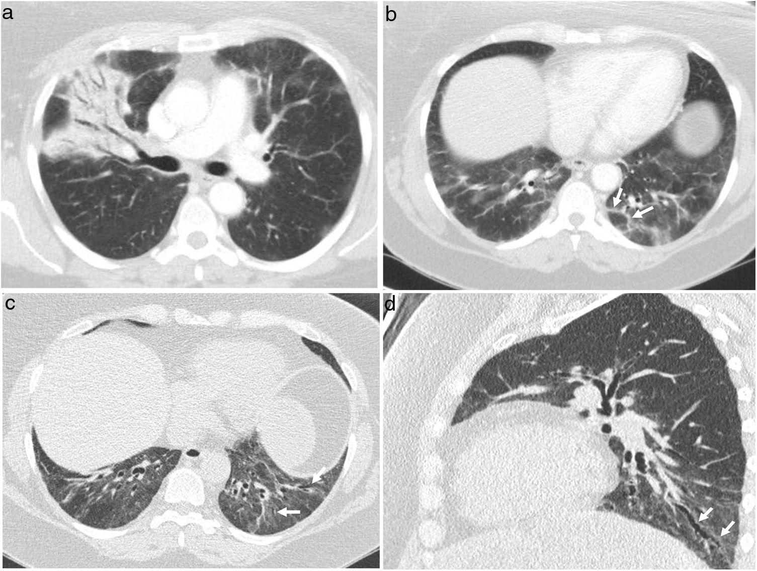Neumonía organizada | Radiología