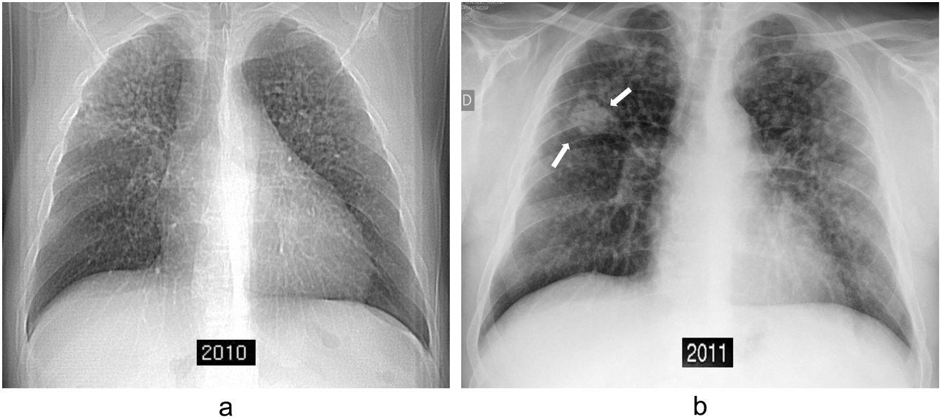 Enfermedades pulmonares inhalatorias | Radiología
