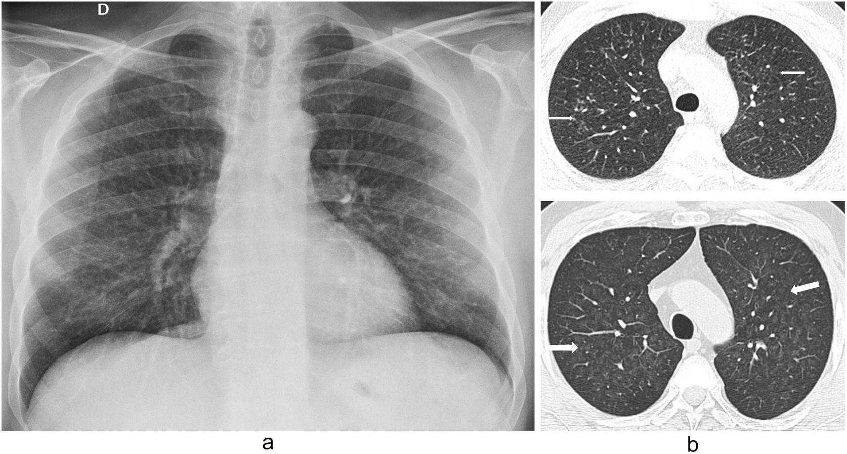 Enfermedades pulmonares inhalatorias | Radiología