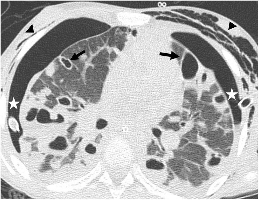 Enfermedades quísticas pulmonares | Radiología