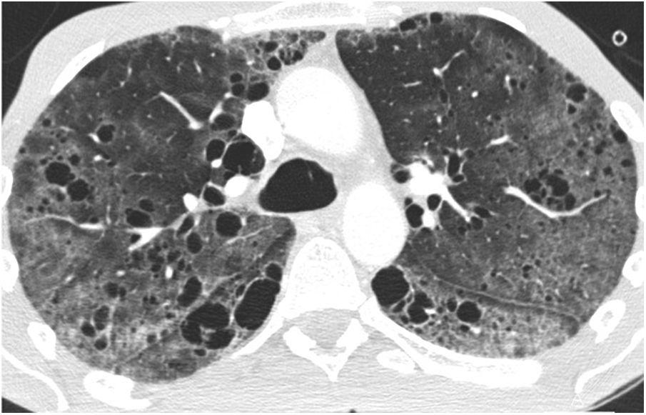 Enfermedades quísticas pulmonares | Radiología