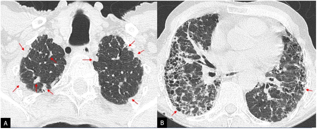 Fibrosis pulmonar idiopática | Radiología