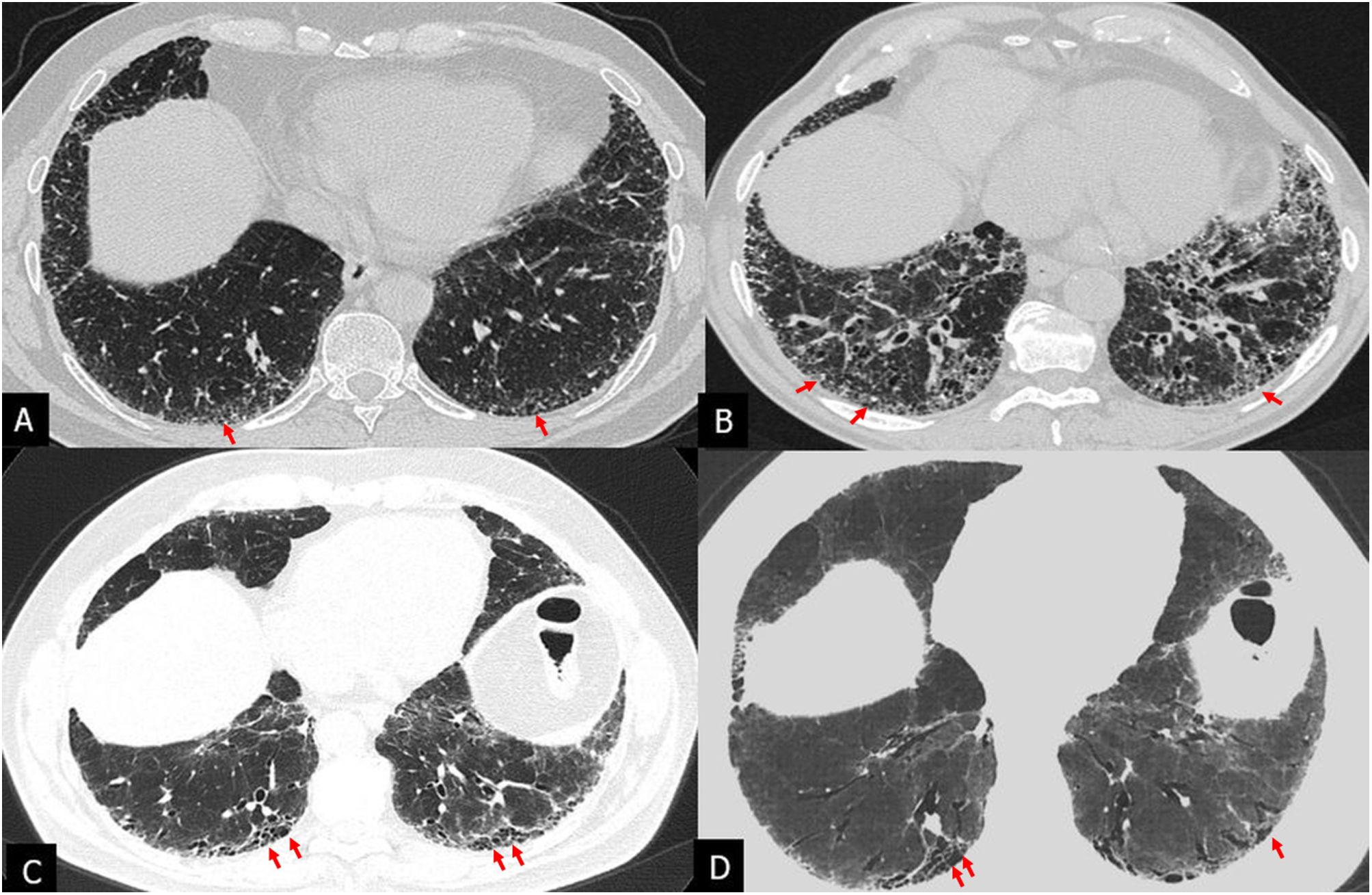 Fibrosis pulmonar idiopática | Radiología