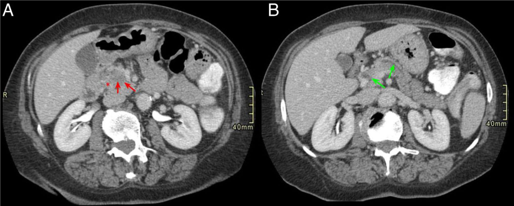 Revisión de la pancreatitis del surco y cómo diferenciarla del ...
