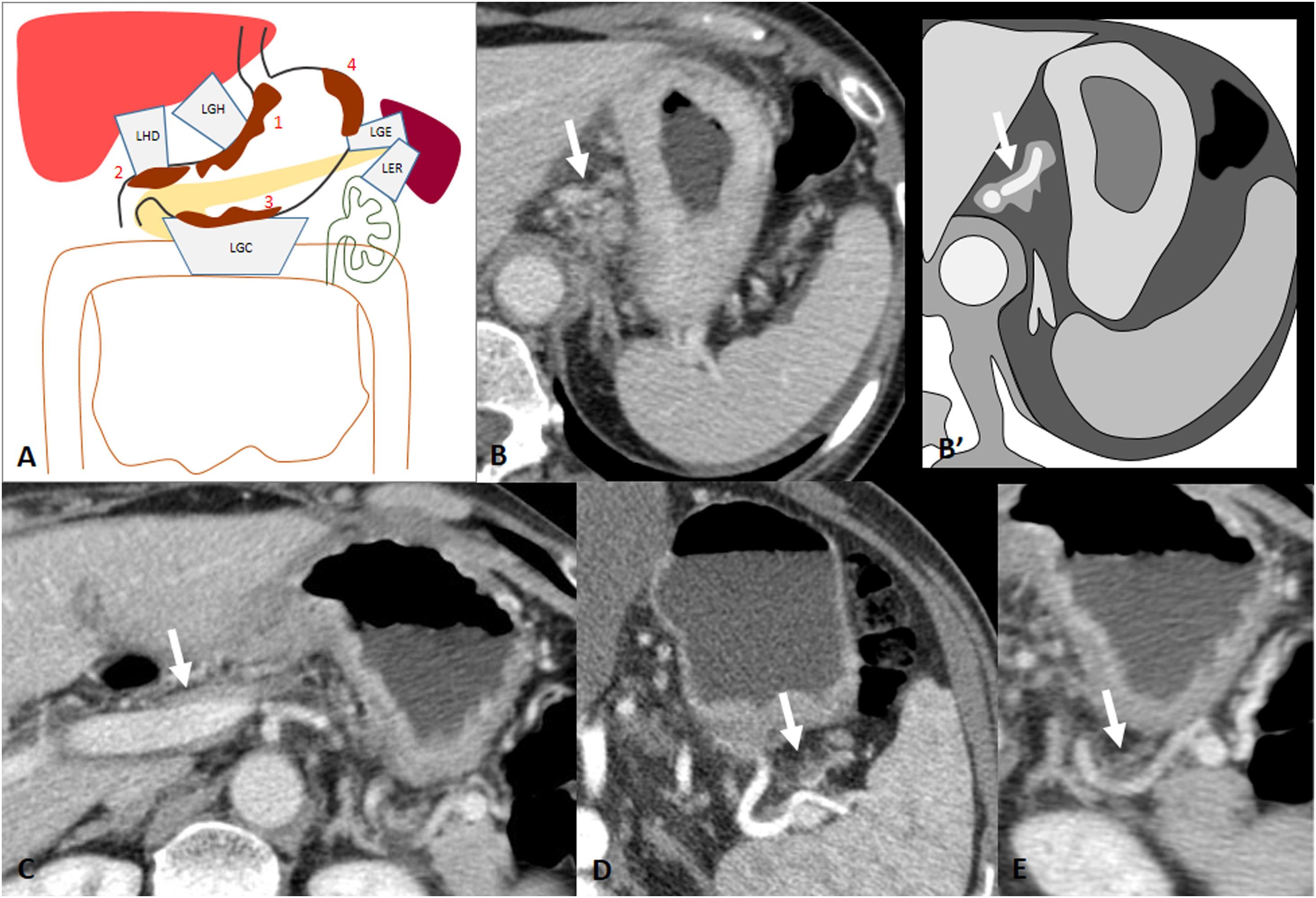 Adenocarcinoma gástrico: revisión del TNM y de las vías de diseminación ...
