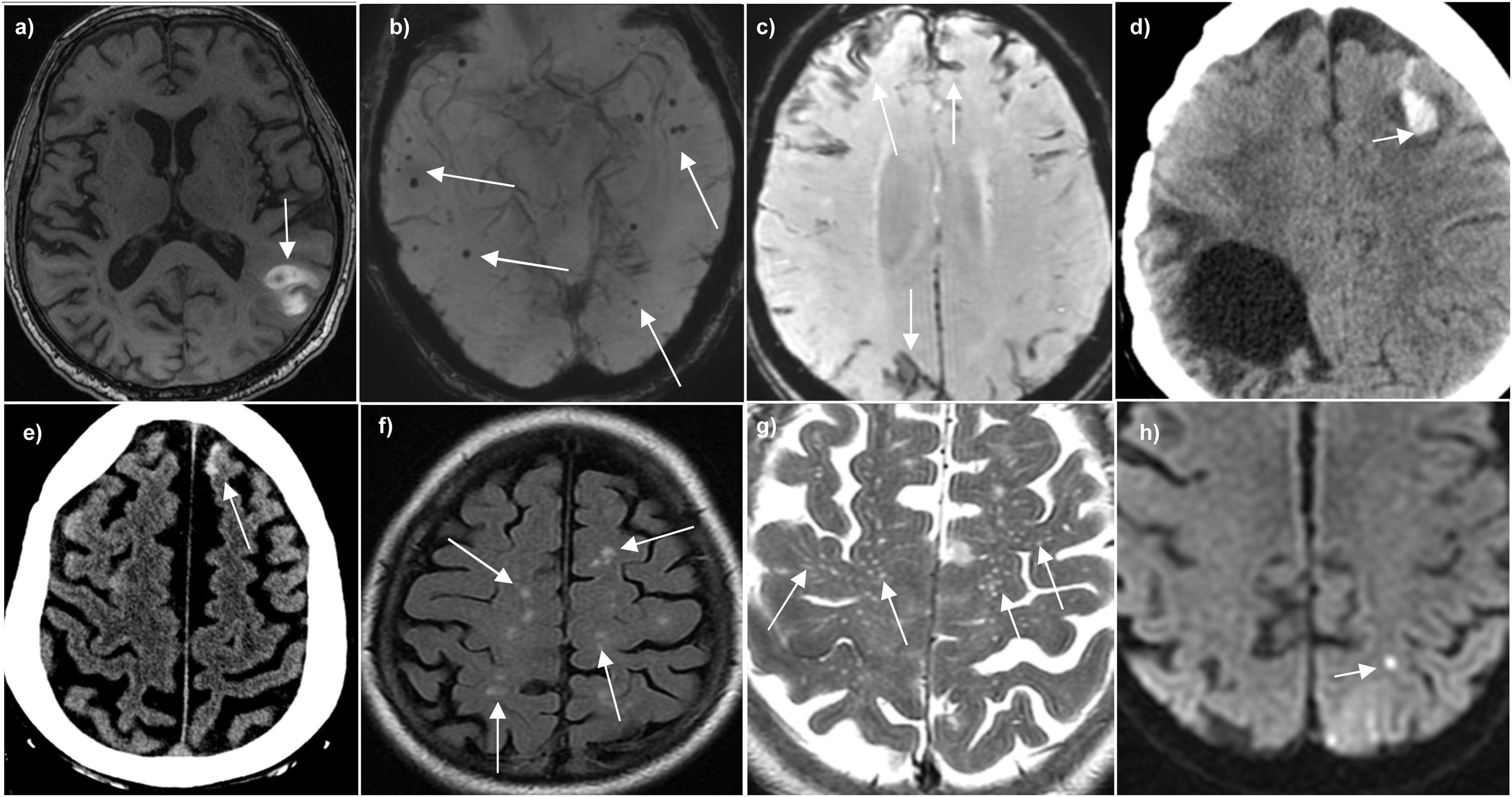 Hemorragia cerebral primaria y secundaria no traumática: Hallazgos en ...