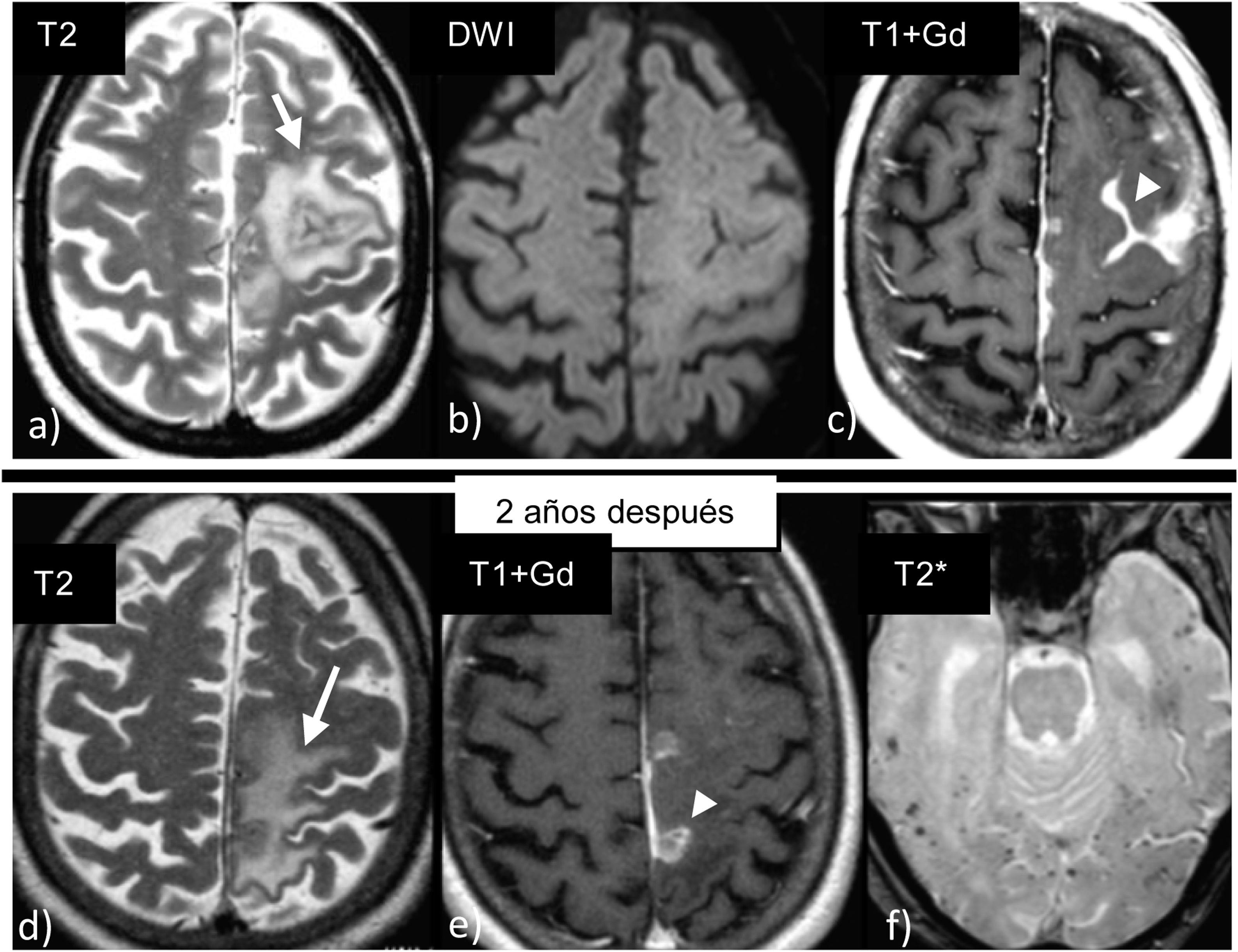 Hemorragia cerebral primaria y secundaria no traumática: Hallazgos en ...