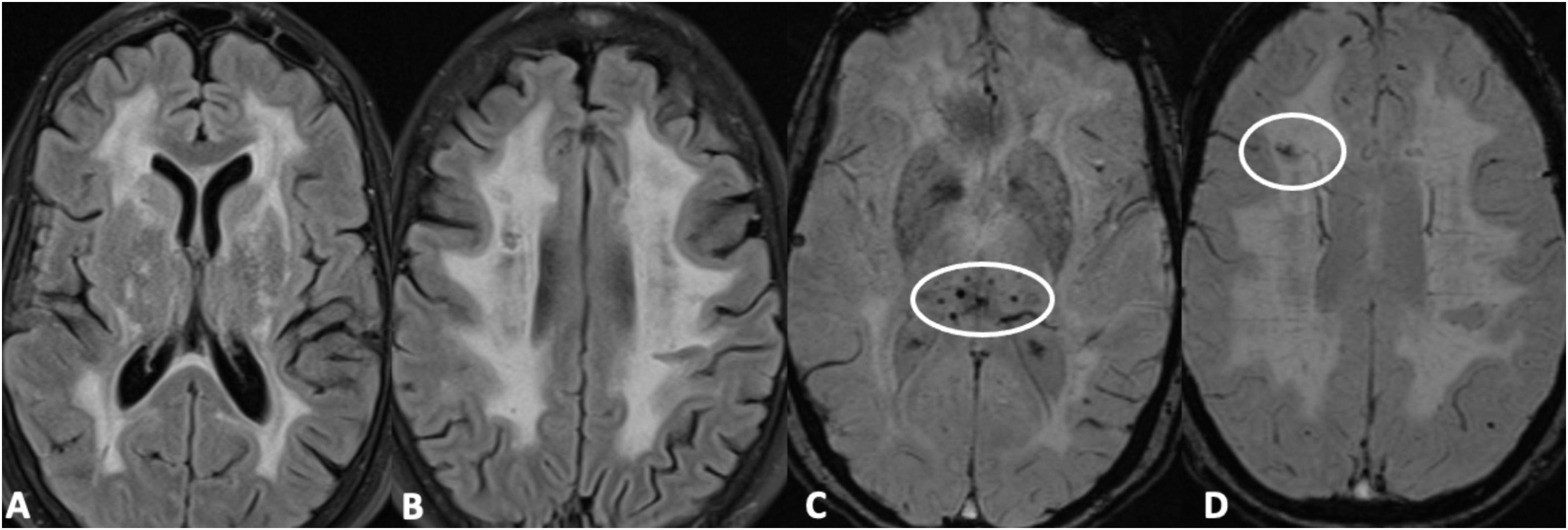 Microhemorragias cerebrales. Utilidad de las secuencias de ...