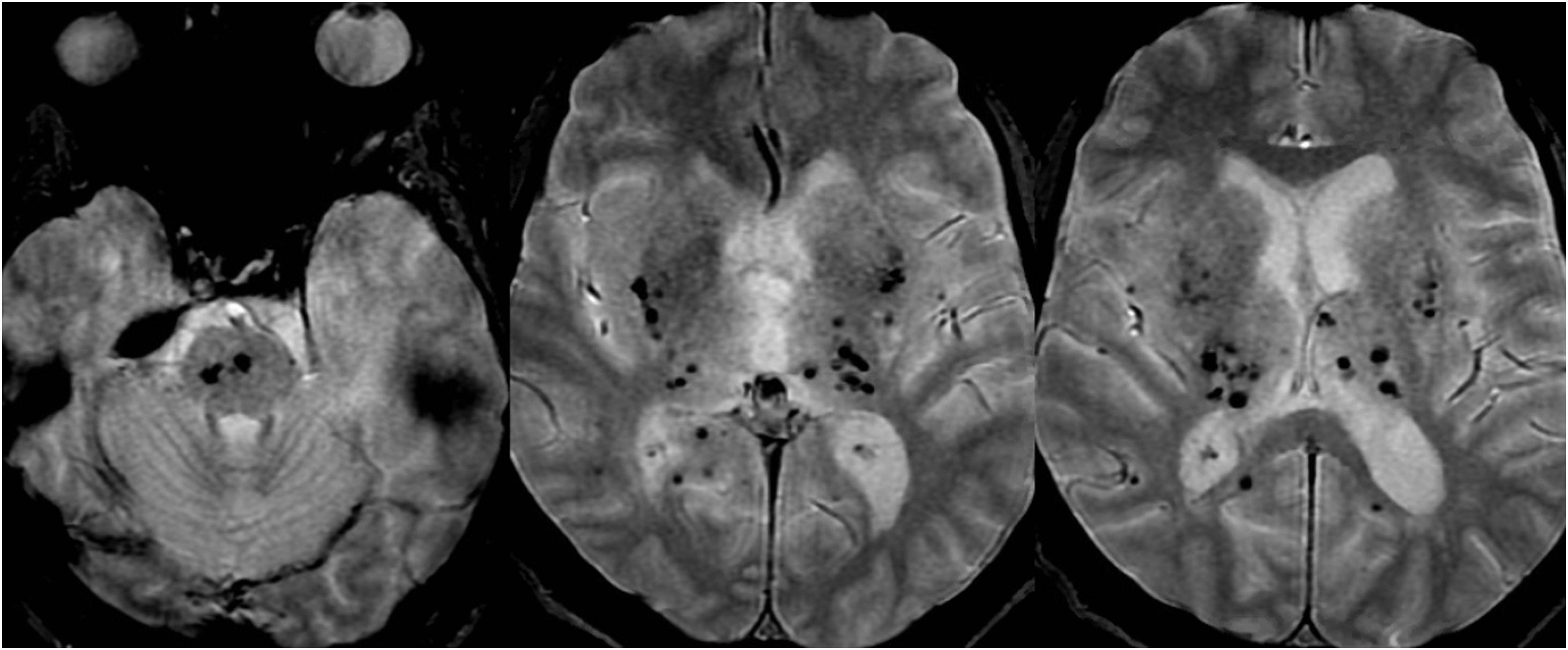 Microhemorragias cerebrales. Utilidad de las secuencias de ...