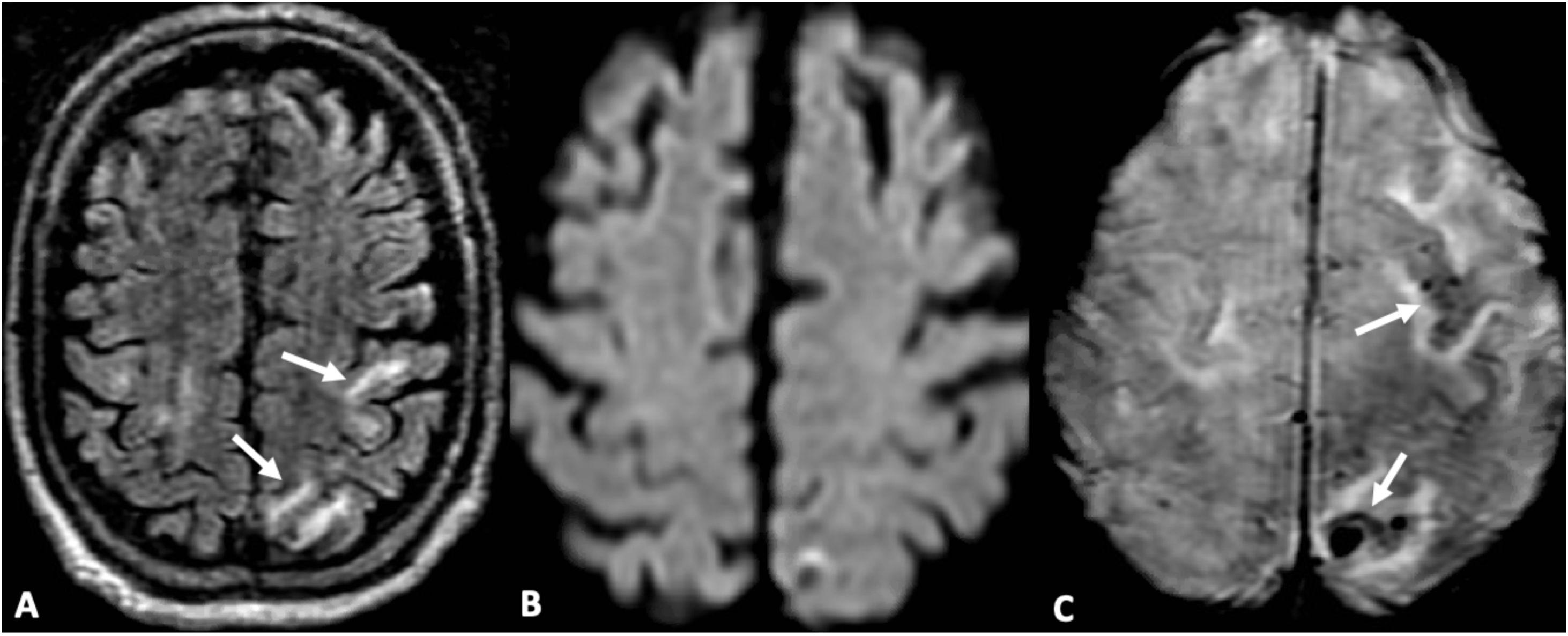 Microhemorragias cerebrales. Utilidad de las secuencias de ...