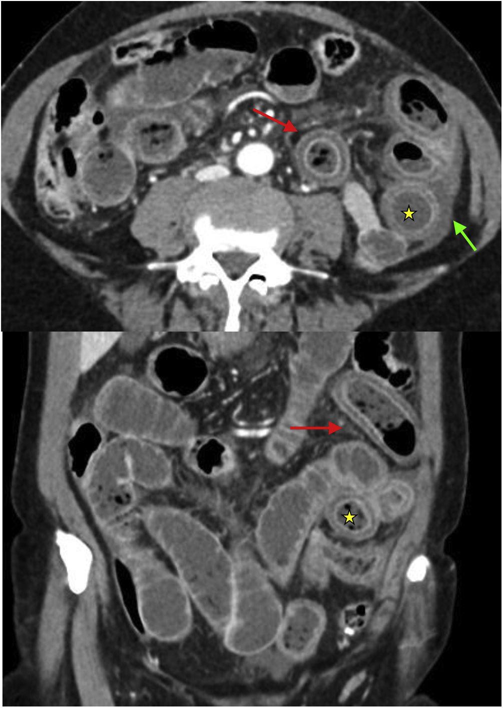 Obstrucción intestinal: signos de indicación quirúrgica urgente ...