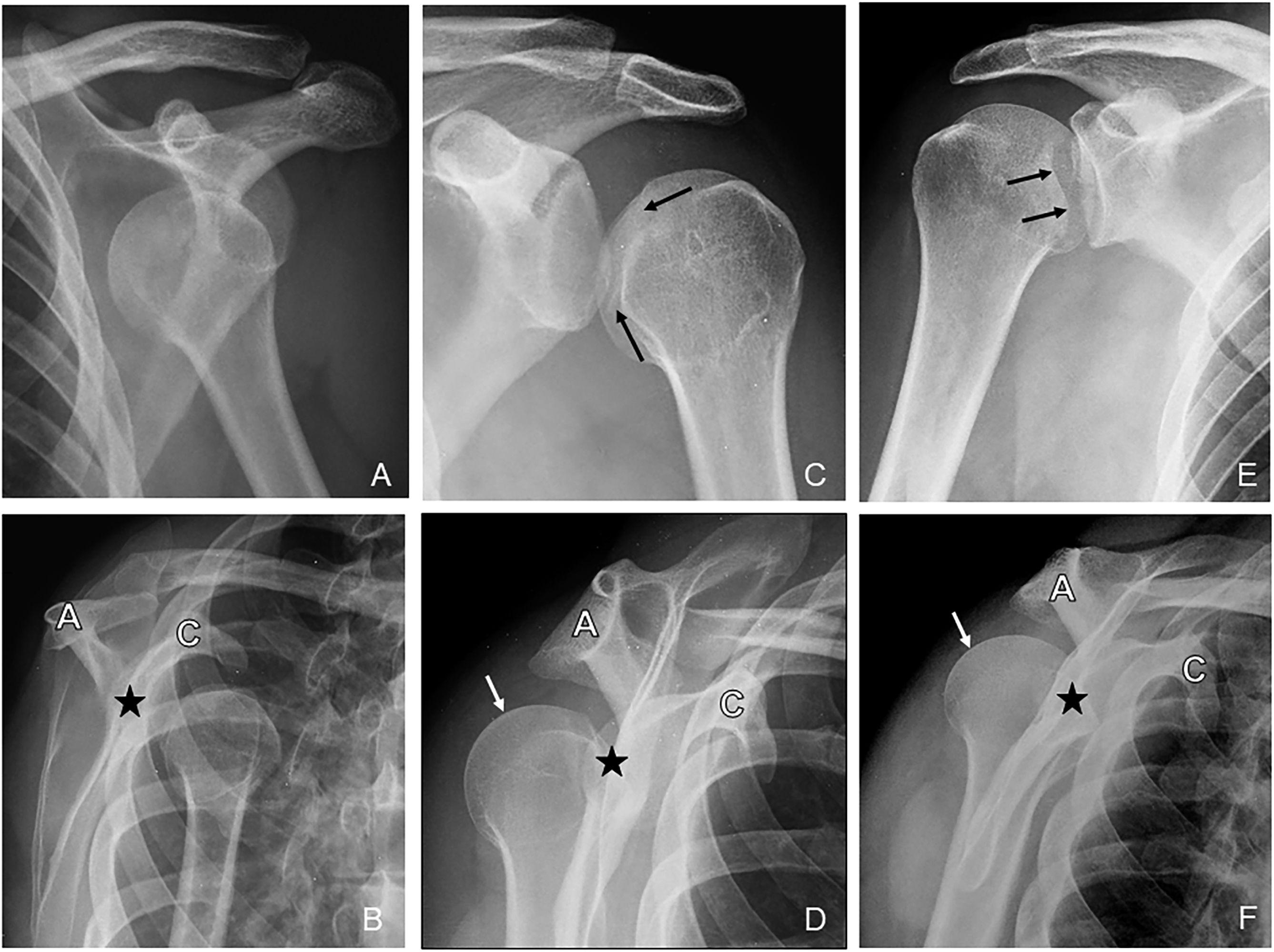 Fracturas de las extremidades: conceptos básicos para la urgencia ...