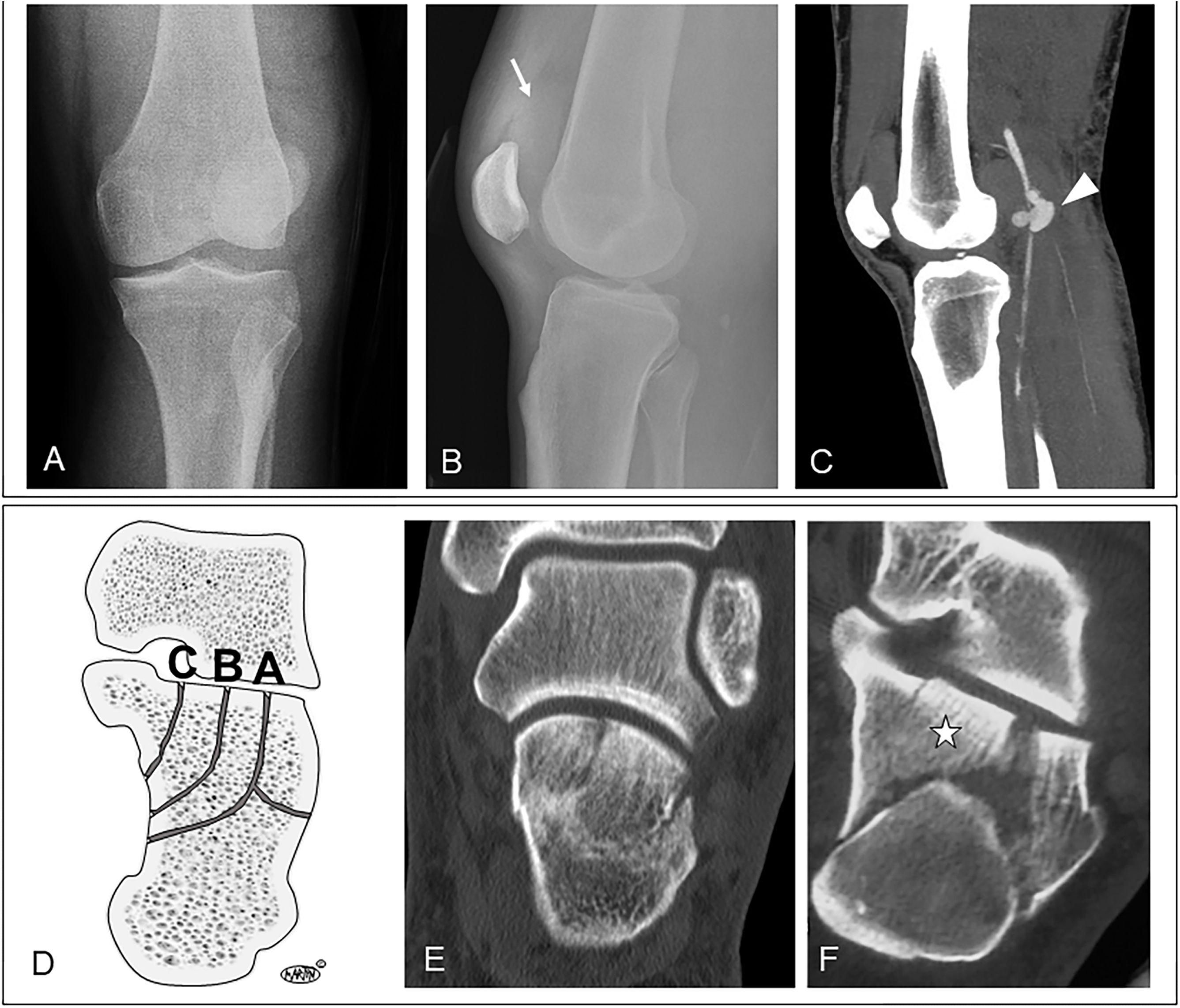 Fracturas de las extremidades: conceptos básicos para la urgencia ...